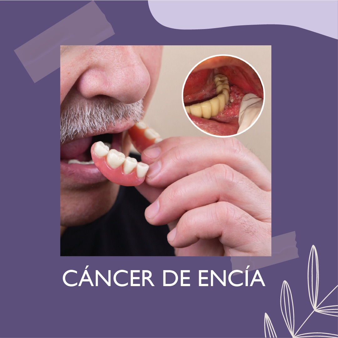 Sabías que las prótesis dentales mal adaptadas pueden causar cáncer de ...